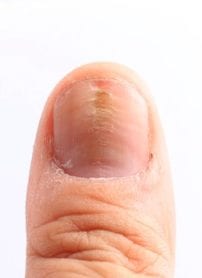 5 Common Nail Conditions